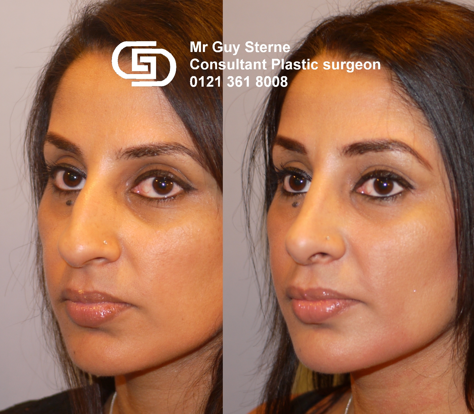 Nose Surgery and Rhinoplasty Birmingham - Guy Sterne