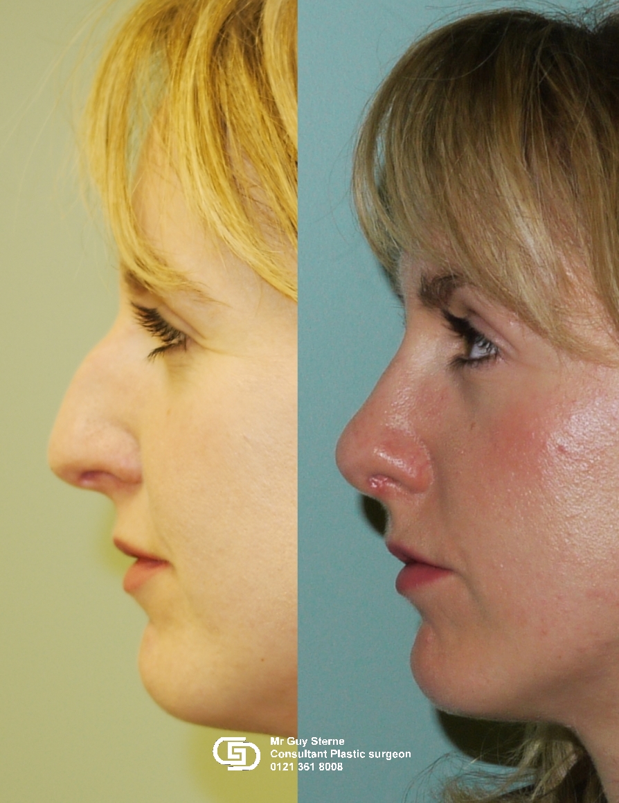 Nose Surgery and Rhinoplasty Birmingham - Guy Sterne